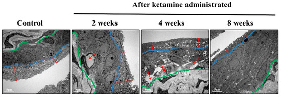 Specific Impacts of Ketamine on Bladder Dysfunction and Associated ...