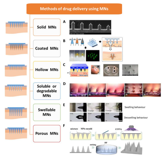 Recent Advances of Microneedles and Their Application in Disease Treatment