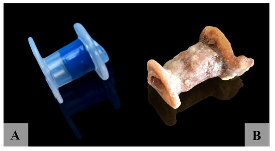 Biocompatible Materials in Otorhinolaryngology and Their Antibacterial ...