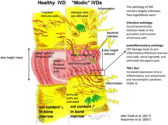Should Degenerated Intervertebral Discs of Patients with Modic Type 1 ...