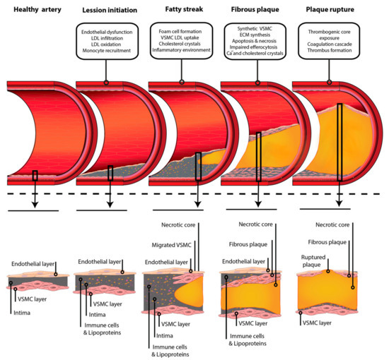 Pathophysiology of Atherosclerosis