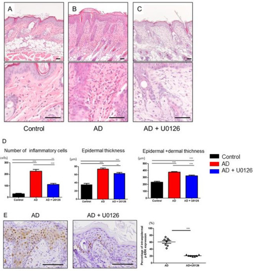 Role of ERK Pathway in the Pathogenesis of Atopic Dermatitis and Its ...