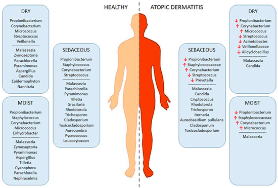 IJMS | Free Full-Text | Skin Microbiota in Atopic Dermatitis