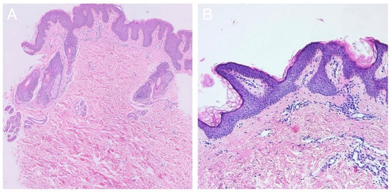 IJMS | Free Full-Text | Identification of Codon 146 KRAS Variants in ...