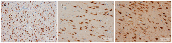Heterozygous and Homozygous Variants in SORL1 Gene in Alzheimer’s ...