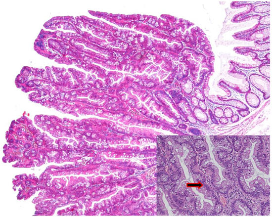 Hyperplastic Polyp Sawtooth