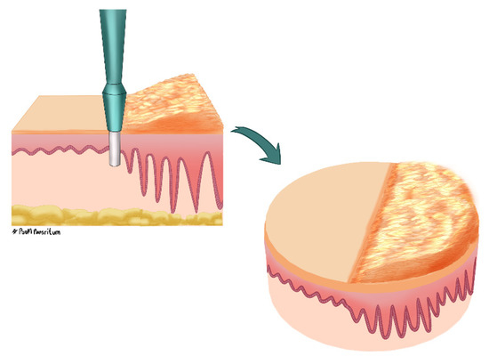 IJMS | Free Full-Text | Transcriptomic Profiling of Peripheral Edge of ...