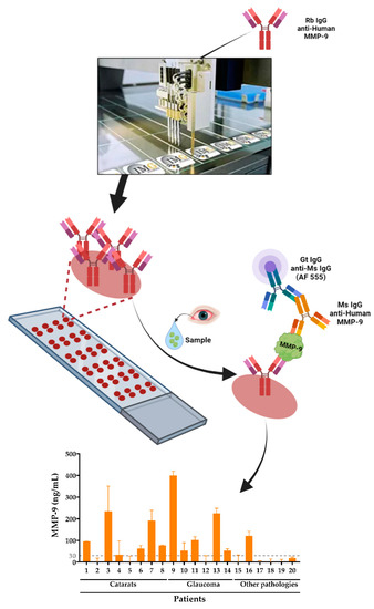 Elevation of Tear MMP-9 Concentration as a Biomarker of Inflammation in ...