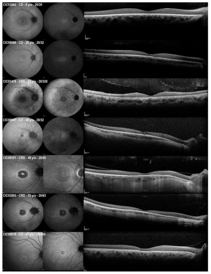 Retrospective Natural History Study of RPGR-Related Cone- and Cone-Rod ...