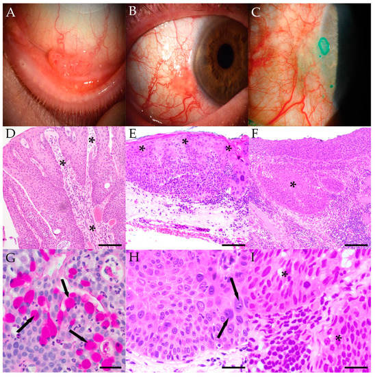 Conjunctival Intraepithelial Neoplasia (cin)