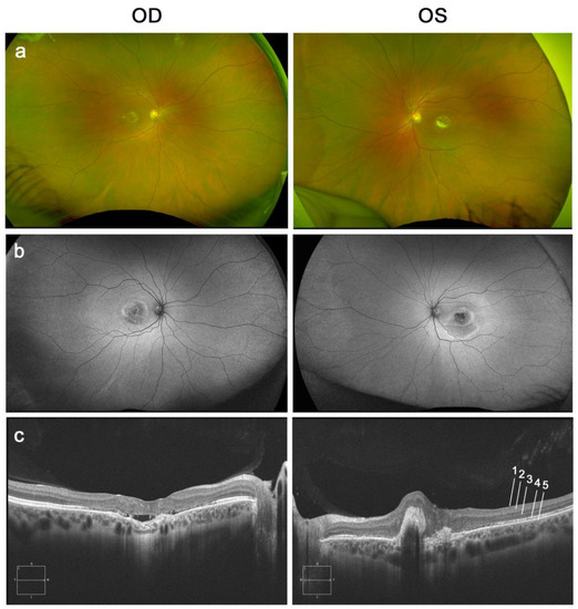 Impaired Bestrophin Channel Activity in an iPSC-RPE Model of Best ...