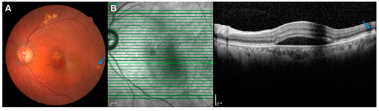 The Association of Pachydrusen Characteristics with Choroidal Thickness ...