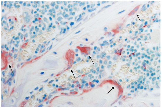 Mechanisms of Systemic Osteoporosis in Rheumatoid Arthritis