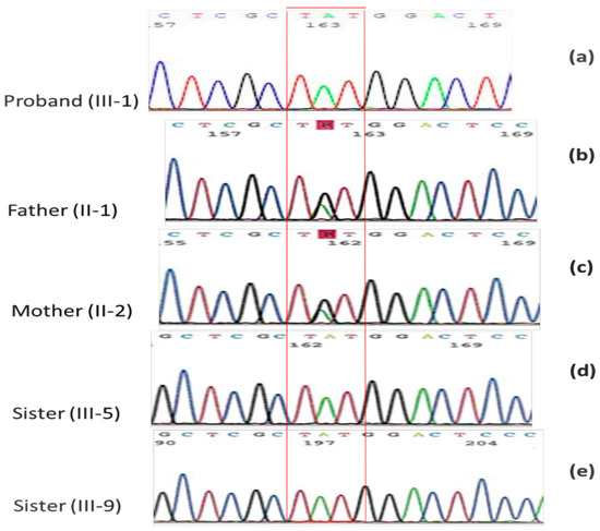 A Novel Homozygous Variant in DYSF Gene Is Associated with Autosomal Recessive Limb Girdle ...