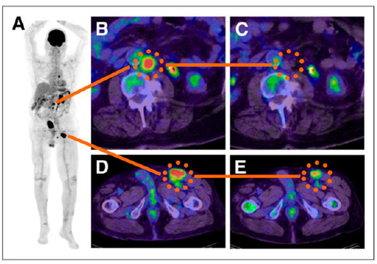 Targeting Melanin in Melanoma with Radionuclide Therapy