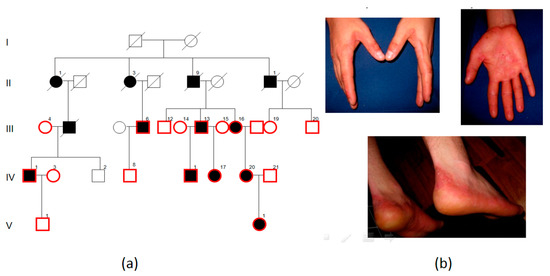IJMS | Free Full-Text | Palmoplantar Keratoderma: A Molecular Genetic ... IJMS | Free Full-Text | Palmoplantar Keratoderma: A Molecular Genetic ...