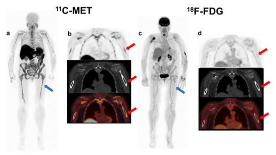 IJMS | Free Full-Text | 11C-Methionine PET/CT in Assessment of Multiple Myeloma Patients ...