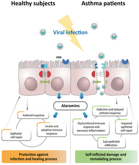 IJMS | Free Full-Text | Viral Infection and Airway Epithelial Immunity in Asthma