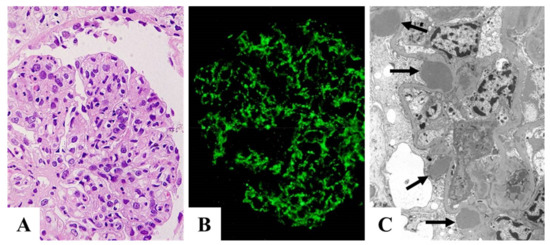 Nephritis-Associated Plasmin Receptor (NAPlr): An Essential Inducer of ...