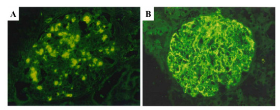 Nephritis-Associated Plasmin Receptor (NAPlr): An Essential Inducer of ...