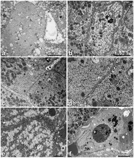 Pathomorphogenesis of Glycogen-Ground Glass Hepatocytic Inclusions ...