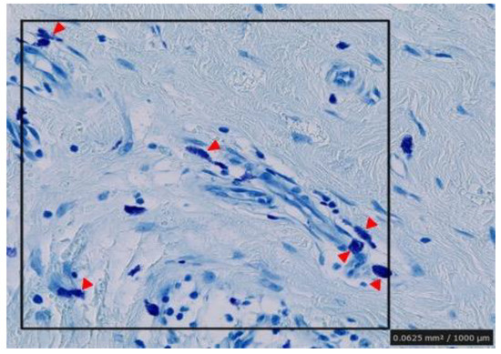 Mast Cells Are Activated in the Giant Earlobe Keloids: A Case Series