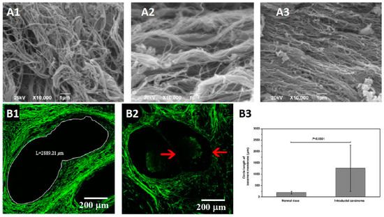 Collagen Remodeling along Cancer Progression Providing a Novel ...
