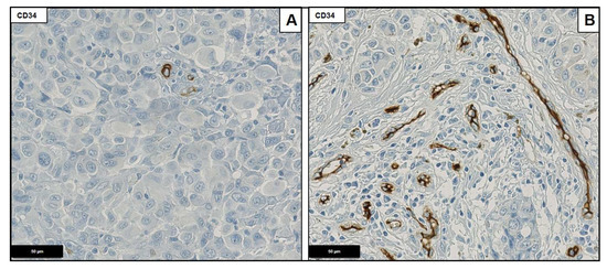 Hypoxia and Ezrin Expression in Primary Melanoma Have High Prognostic ...