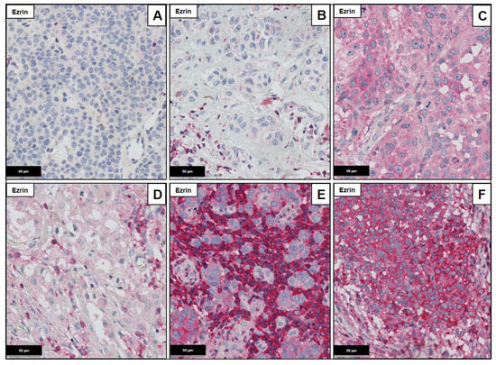 Hypoxia and Ezrin Expression in Primary Melanoma Have High Prognostic ...
