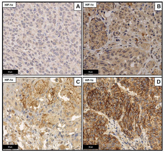 Hypoxia and Ezrin Expression in Primary Melanoma Have High Prognostic ...