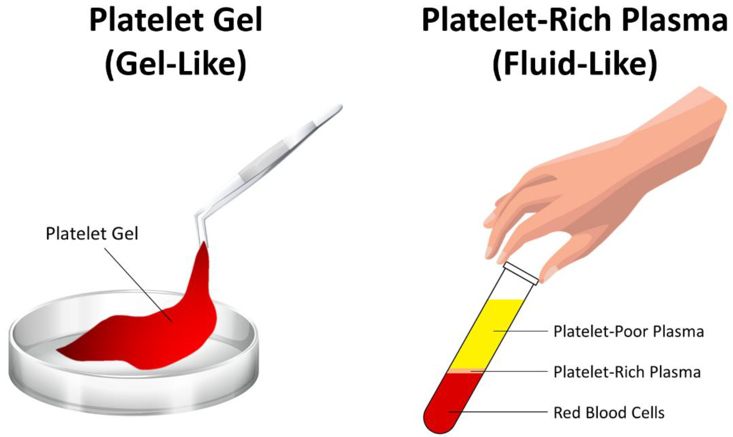 Treatment Effect of Platelet Gel on Reconstructing Bone Defects and Nonunions: A Review of In ...