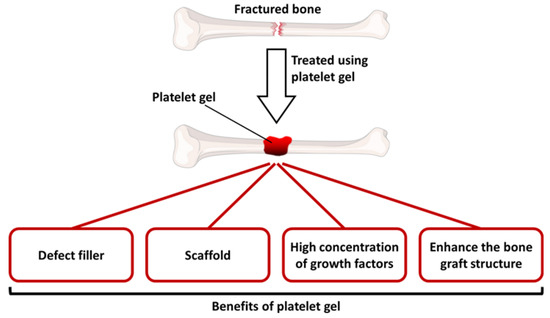 Treatment Effect of Platelet Gel on Reconstructing Bone Defects and ...