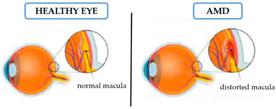 IJMS | Free Full-Text | Therapeutic Approaches for Age-Related Macular ...