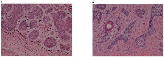 Molecular Mechanisms and Targeted Therapies of Advanced Basal Cell ...