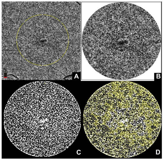 Choroidal Vasculature Changes in Age-Related Macular Degeneration: From ...