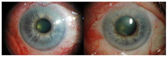 Understanding Ocular Findings and Manifestations of Systemic Lupus ...