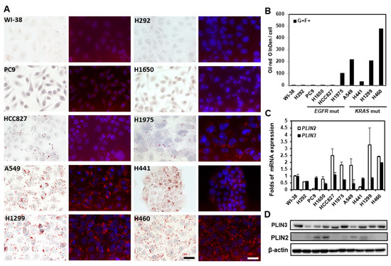 Lipid Droplets in Lung Cancers Are Crucial for the Cell Growth and ...
