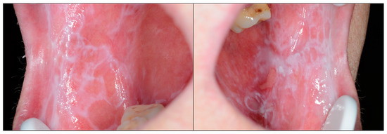 Ijms Free Full Text Hallmarks Of Cancer Expression In Oral Lichen