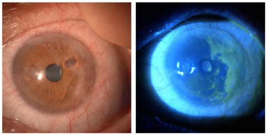 Corneal Epithelial Regeneration: Old and New Perspectives