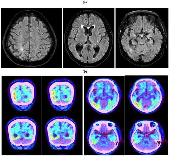 PSEN2 Thr421Met Mutation in a Patient with Early Onset Alzheimer’s Disease