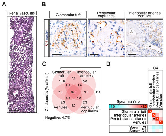 Relevance of Complement C4 Deposits Localized to Distinct Vascular ...
