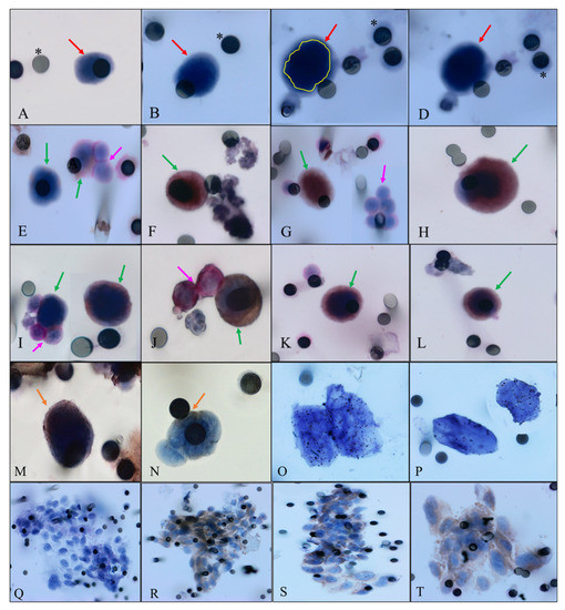 Fusion Cell Markers in Circulating Tumor Cells from Patients with High ...