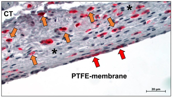 Barrier Membranes for Guided Bone Regeneration (GBR): A Focus on Recent ...