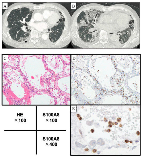 Pathological Roles of Pulmonary Cells in Acute Lung Injury: Lessons ...