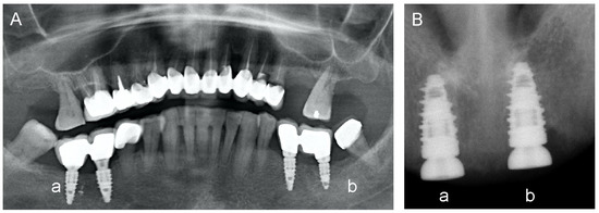 Use of CGF in Oral and Implant Surgery: From Laboratory Evidence to ...