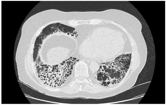 Are There Differences in Inflammatory and Fibrotic Pathways between ...