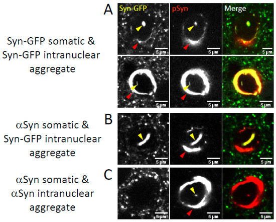 Aggregated Alpha-Synuclein Inclusions within the Nucleus Predict ...