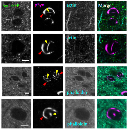 Aggregated Alpha-Synuclein Inclusions within the Nucleus Predict ...