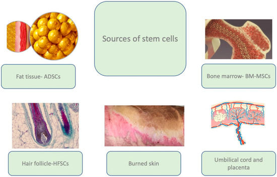 Mesenchymal Stem Cells in Burn Wound Management