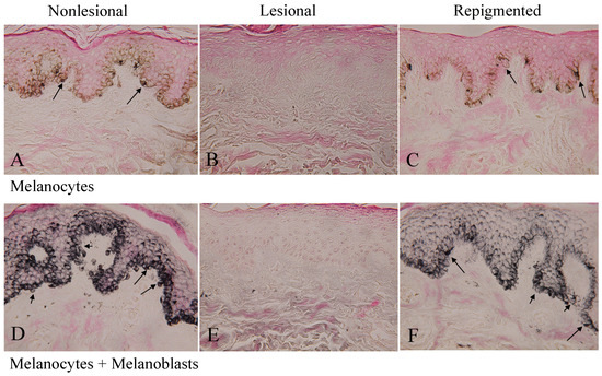 Reduced Elastin Fibers and Melanocyte Loss in Vitiliginous Skin Are ...